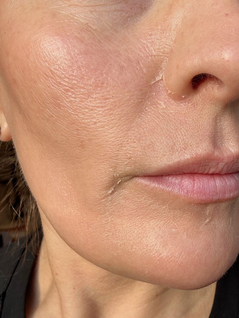VI Peel TOX Booster: Why Combine a Chemical Peel with Botox?