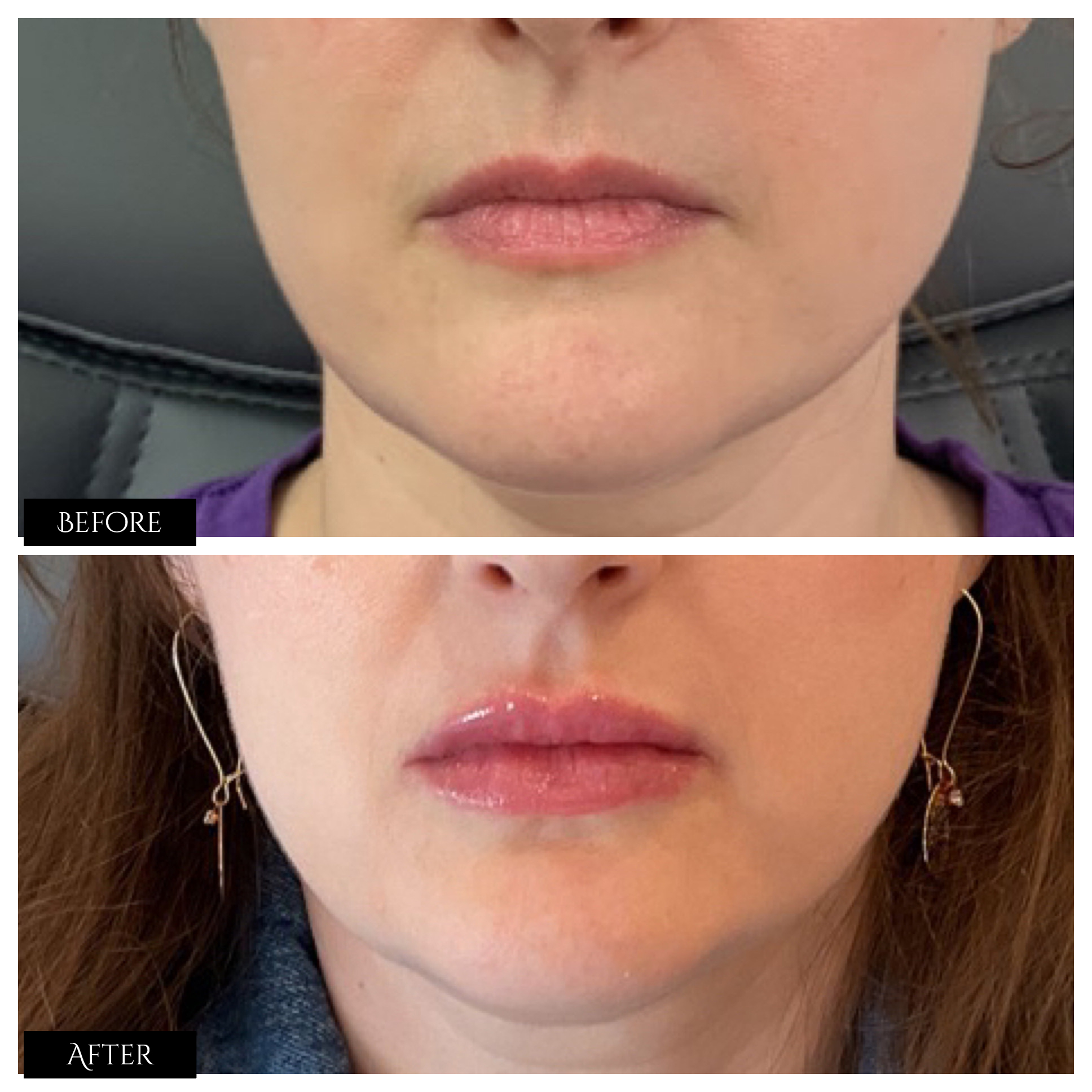 Natural-looking Results with Fillers at Direct Aesthetics