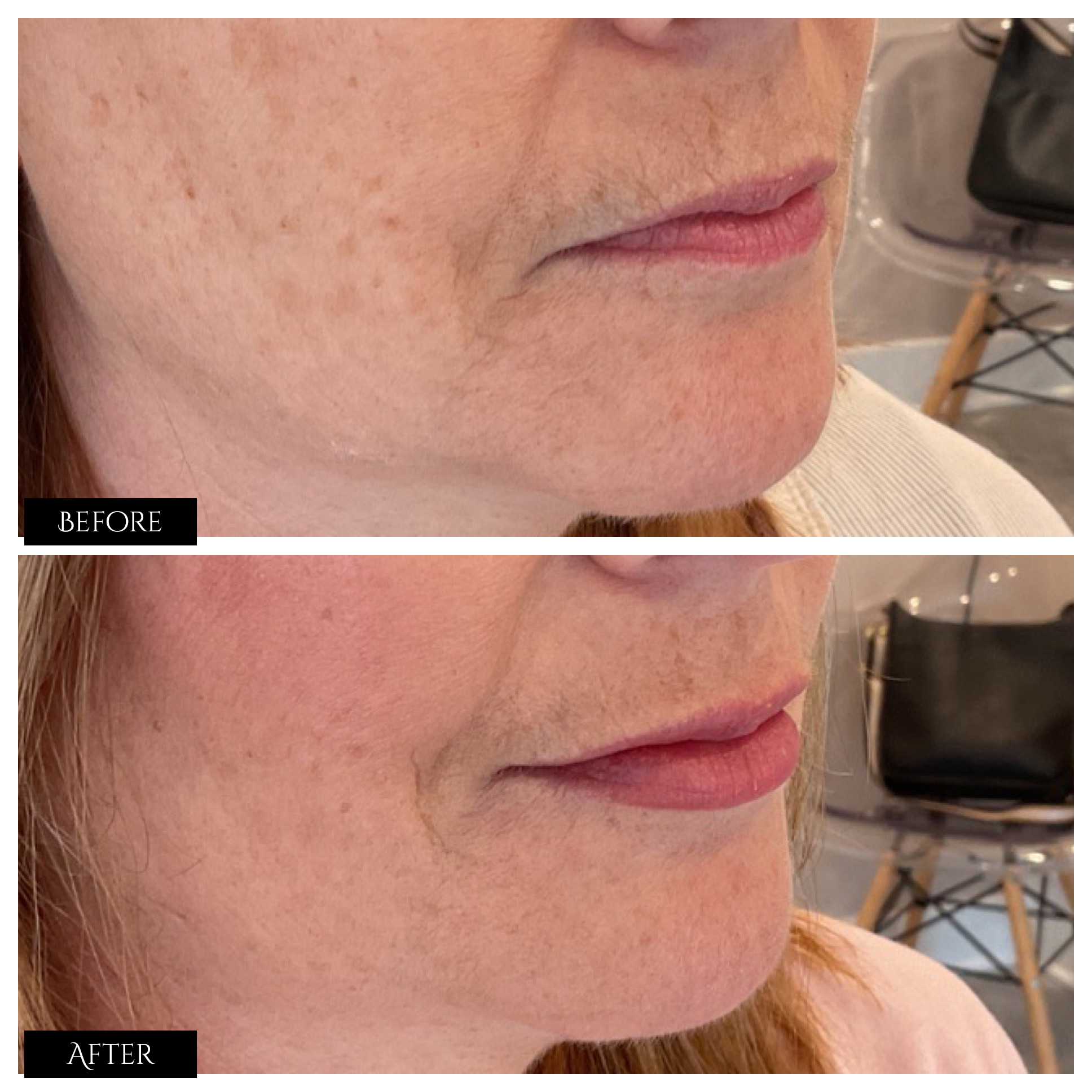 Treatments and Procedures: Dermal Fillers | Direct Aesthetics
