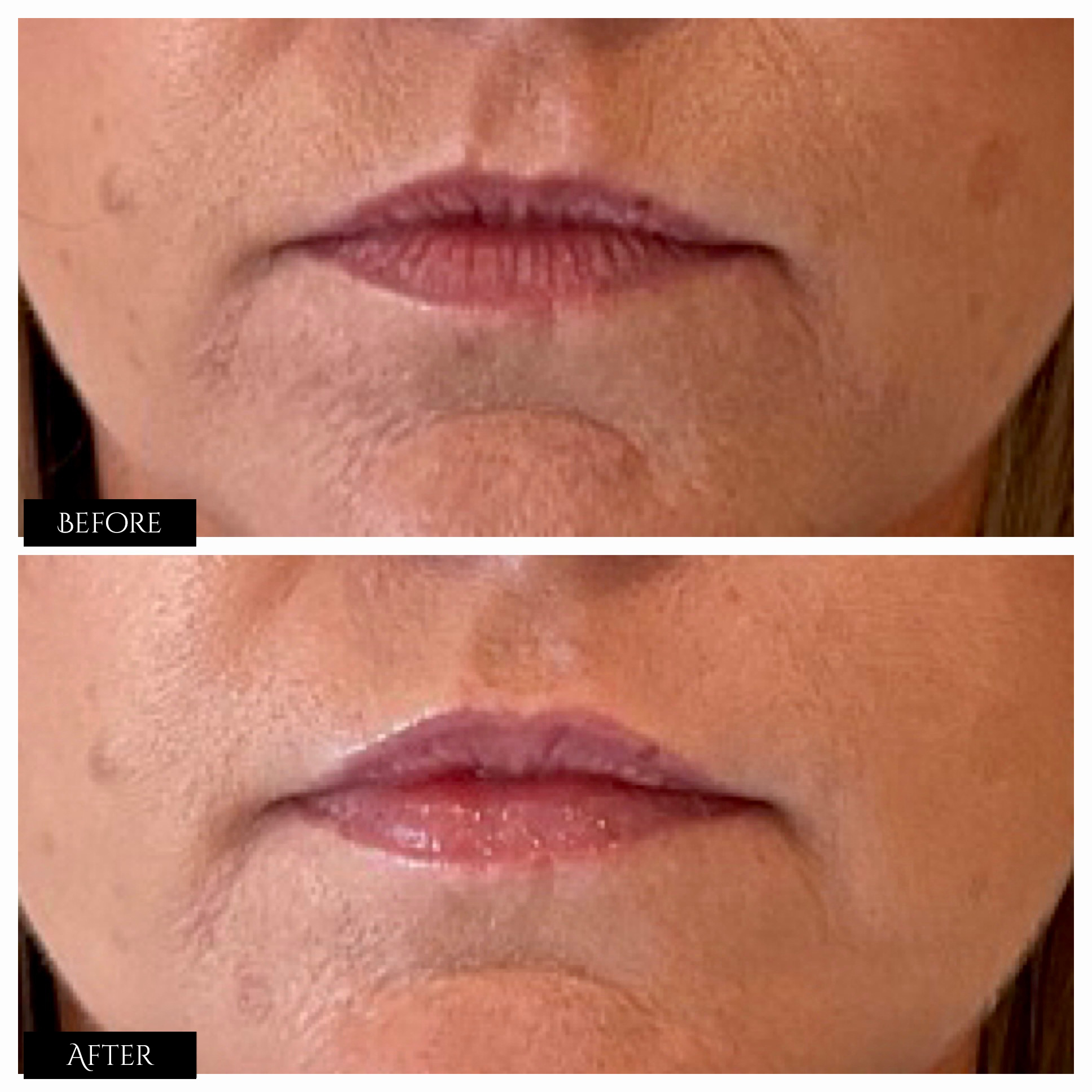 Dermal Fillers | Facial Fillers Near Rockford, MI | Direct Aesthetics
