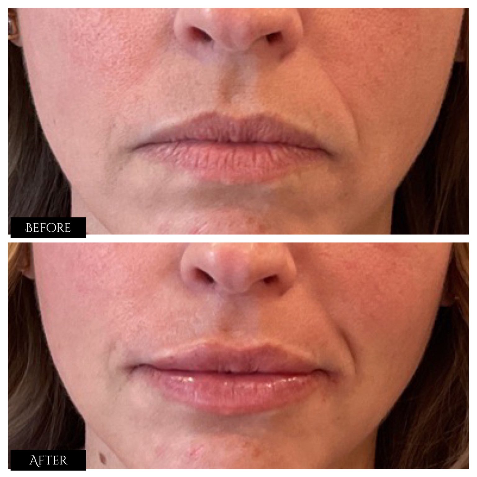Dermal Fillers | Facial Fillers Near Rockford, MI | Direct Aesthetics