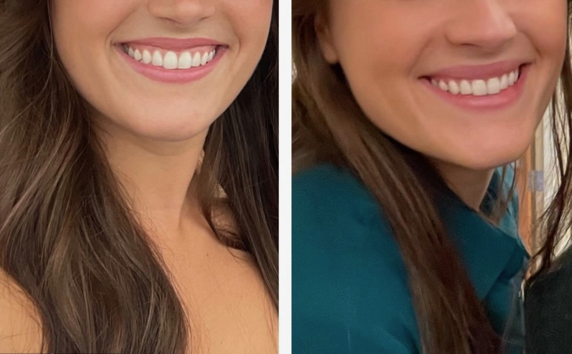 Lip Flip vs. Lip Filler: Choosing the Right Enhancement | Direct Aesthetics
