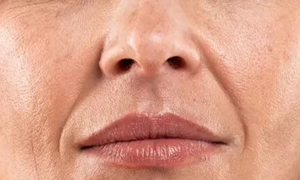 Sculptra Treatments | Sculptra Injections for Facial Aesthetics