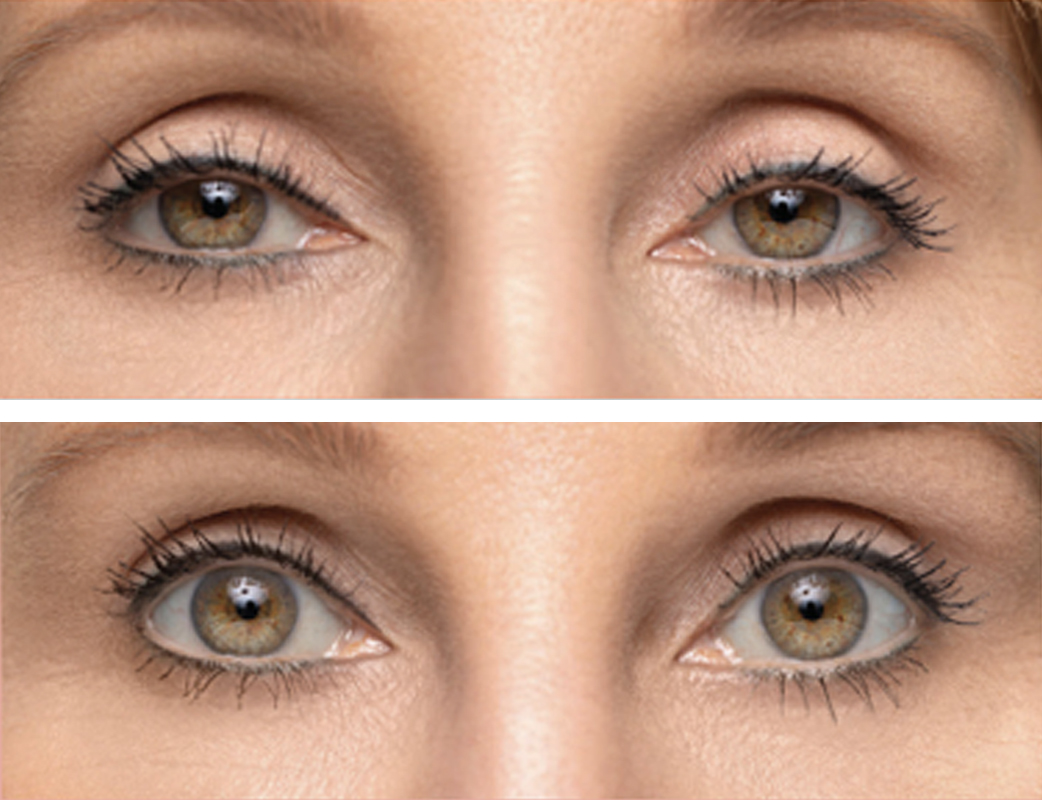 Upneeq - FDA-Approved Ptosis Treatment Practice | Direct Aesthetics