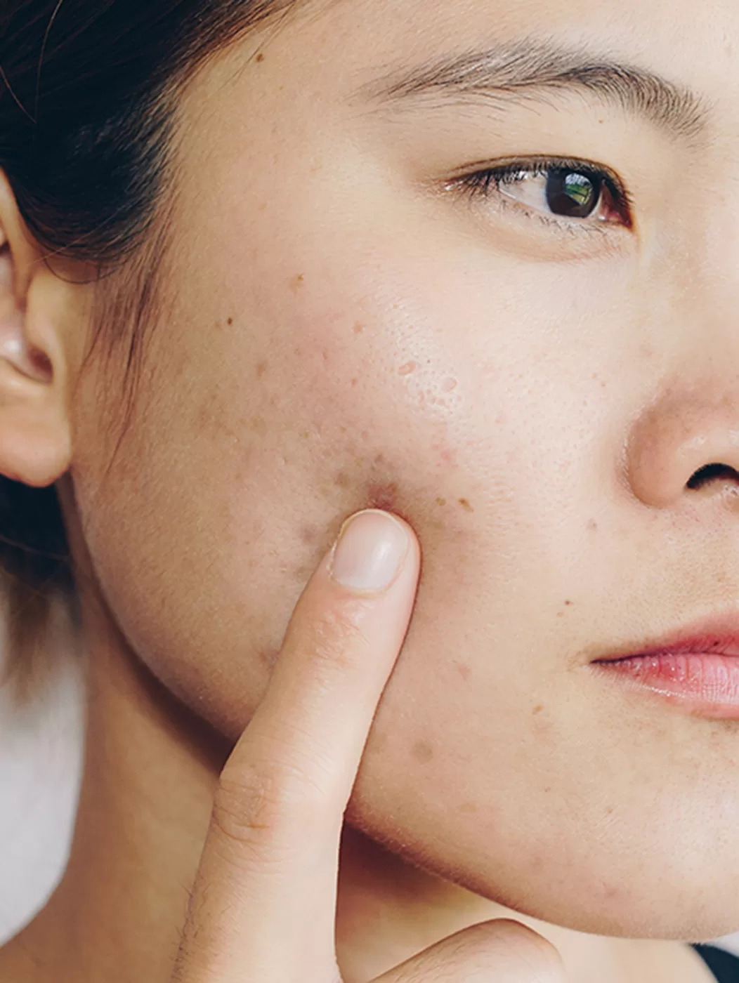 Is Your Skin Experiencing Retinol Purging? 8 Signs of Skin Purging