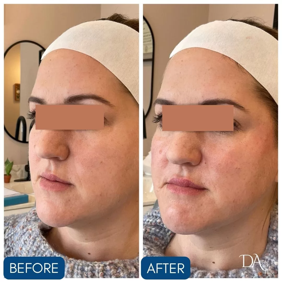 Facial Balancing: Before and After Treatment | Direct Aesthetics