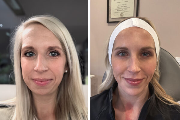 Facial Balancing: Before and After Treatment