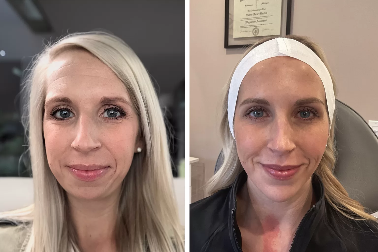 Facial Balancing: Before and After Treatment | Direct Aesthetics