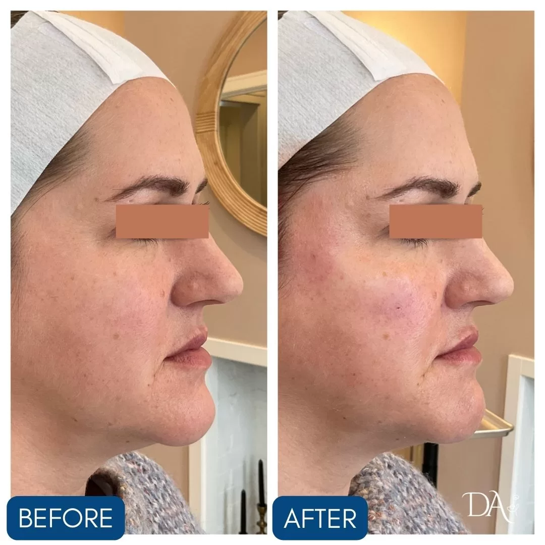 Facial Balancing: Before and After Treatment | Direct Aesthetics