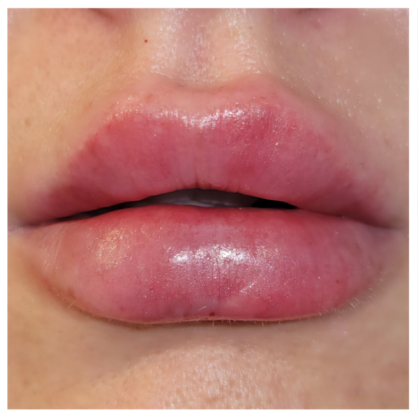 Lip Filler Swelling Timeline: How Long Will It Last?