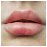Lip Filler Swelling Timeline: How Long Will It Last?