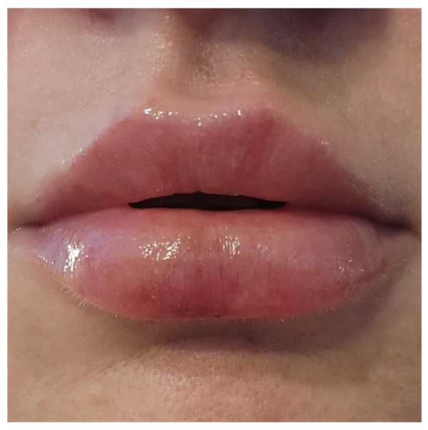 Lip Filler Swelling Timeline: How Long Will It Last?