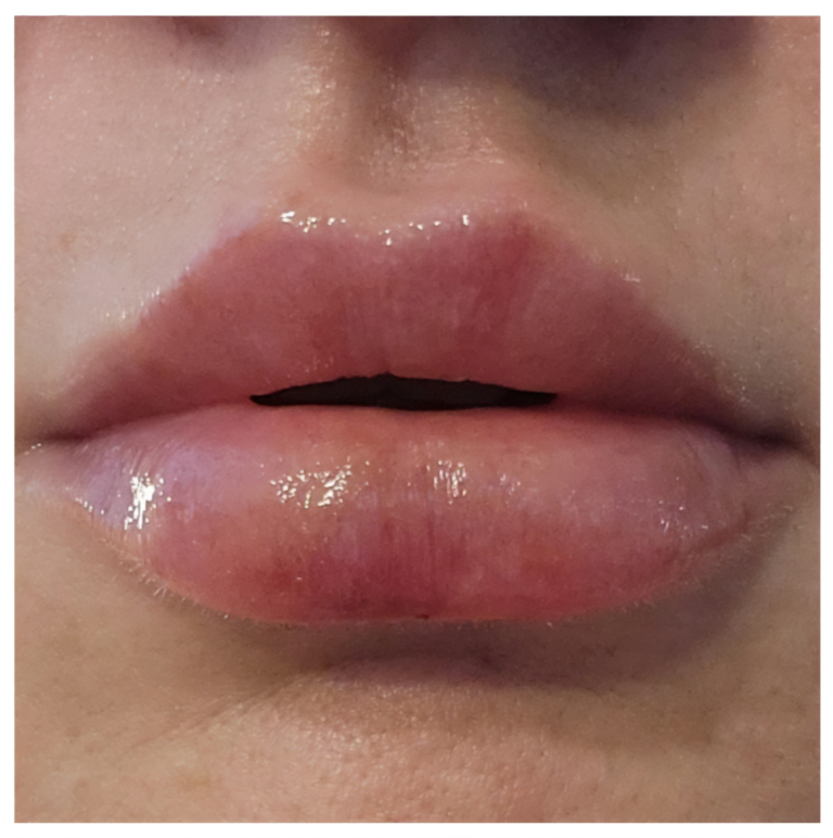 Lip Filler Swelling Timeline: How Long Will It Last?