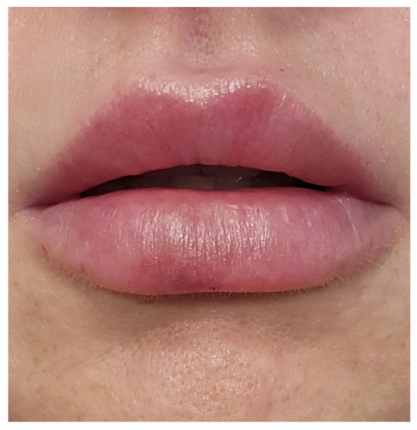 Lip Filler Swelling Timeline: How Long Will It Last?
