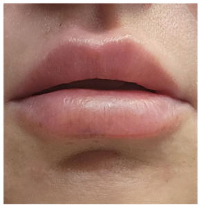 Lip Filler Swelling Timeline: How Long Will It Last?