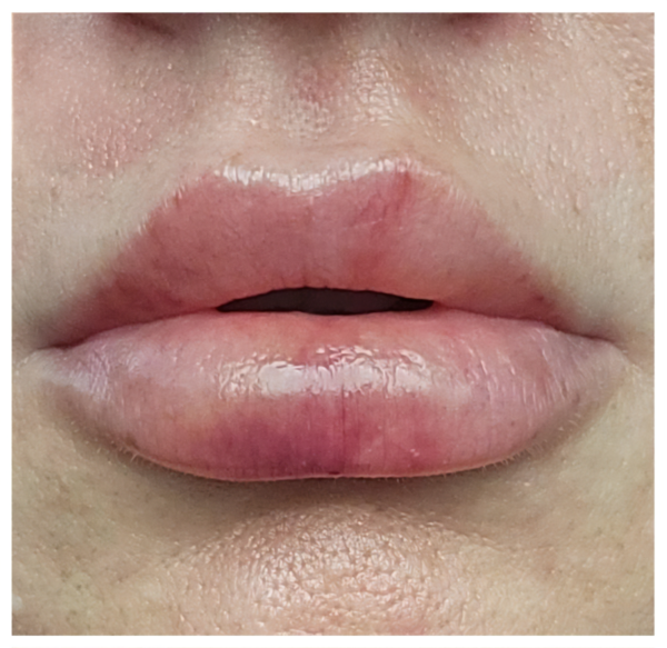 Lip Filler Swelling Timeline: How Long Will It Last?