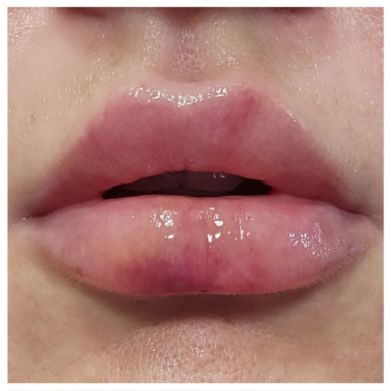 Lip Filler Swelling Timeline: How Long Will It Last?