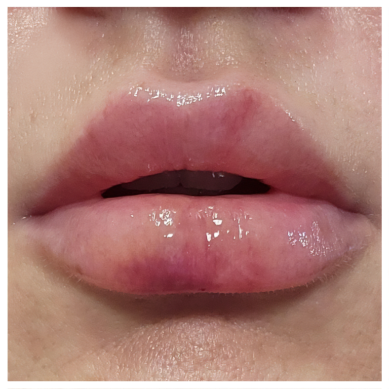 Lip Filler Swelling Timeline: How Long Will It Last?
