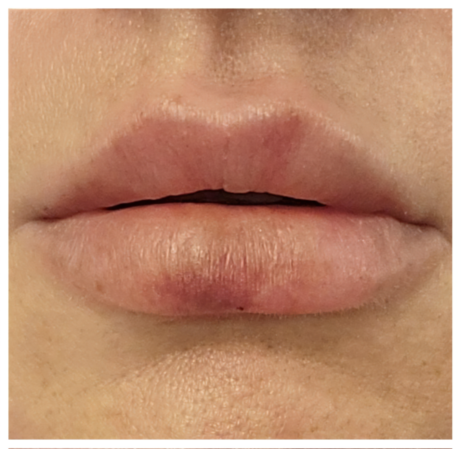 Lip Filler Swelling Timeline: How Long Will It Last?