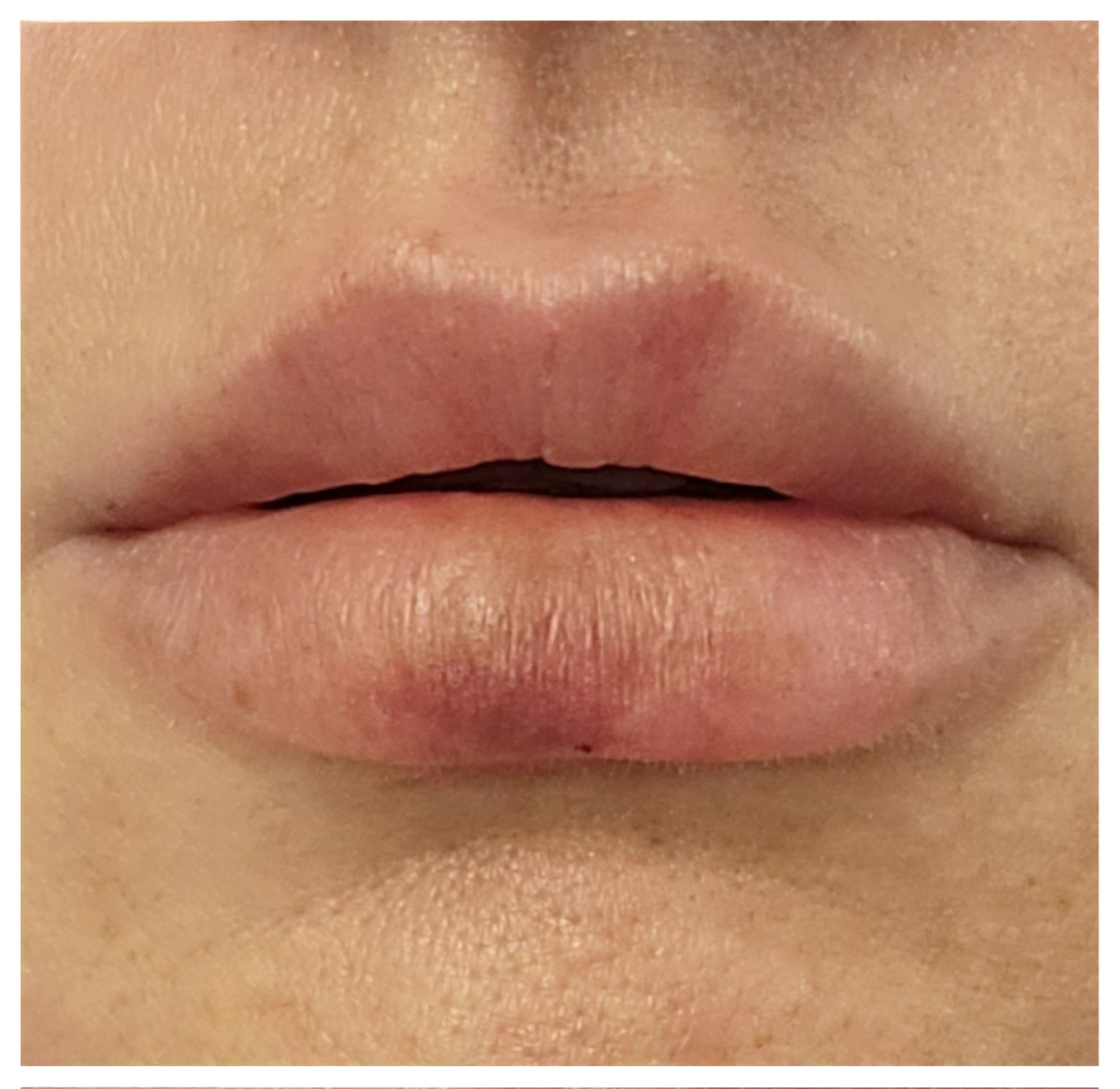 Lip Filler Swelling Timeline: How Long Will It Last?