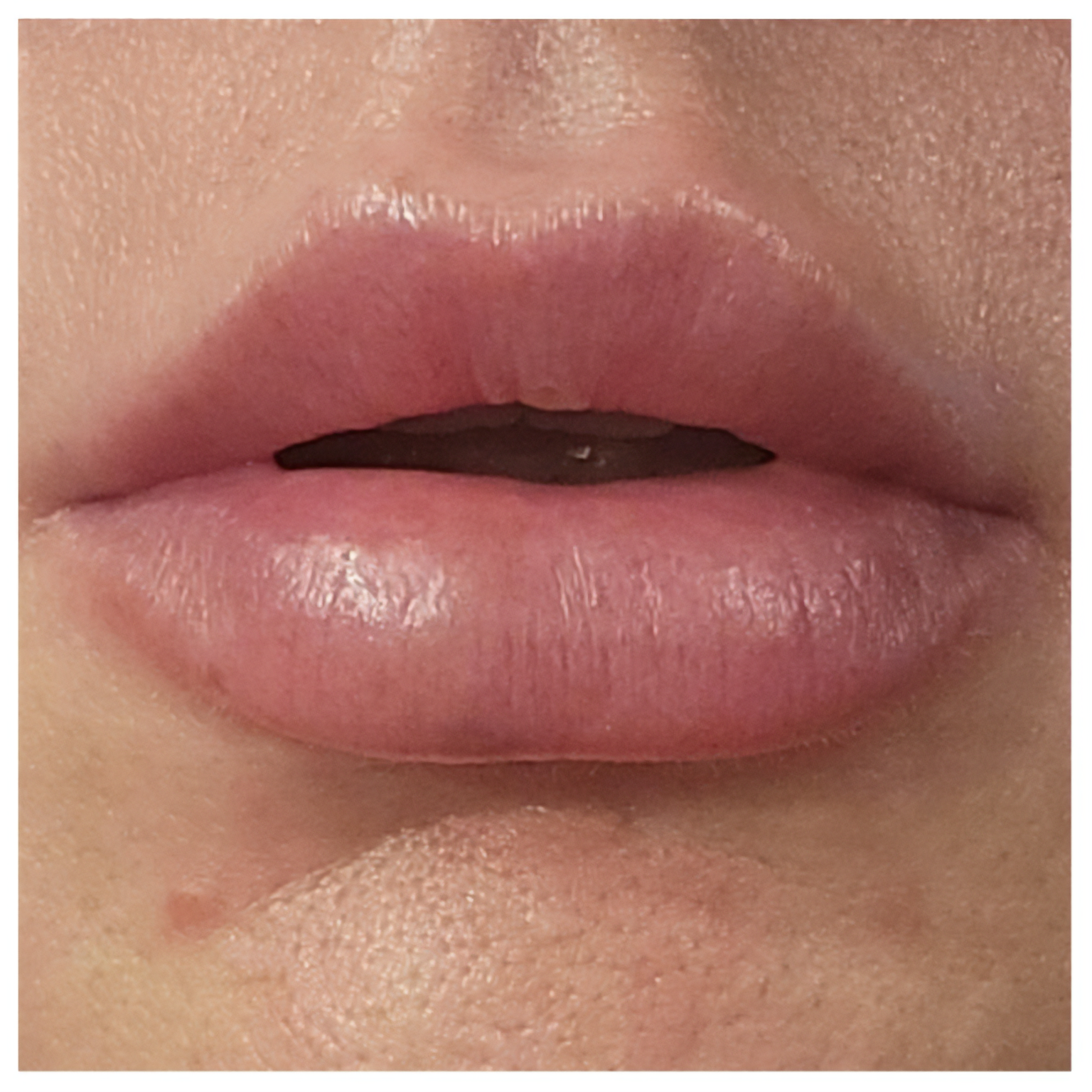 Lip Filler Swelling Timeline: How Long Will It Last?