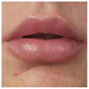 Lip Filler Swelling Timeline: How Long Will It Last?