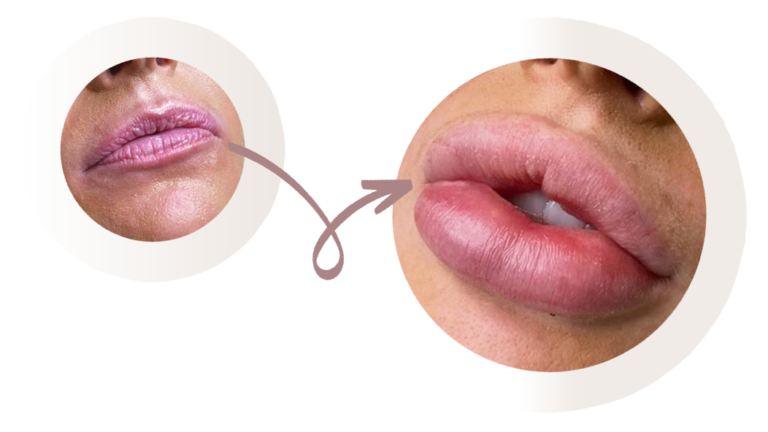 Lip Filler Swelling Timeline: How Long Will It Last?
